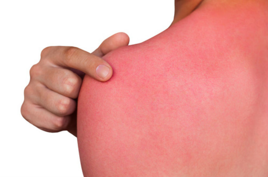 Study Finds Vitamin D May Play Huge Role In Alleviating Symptoms Of Sunburn